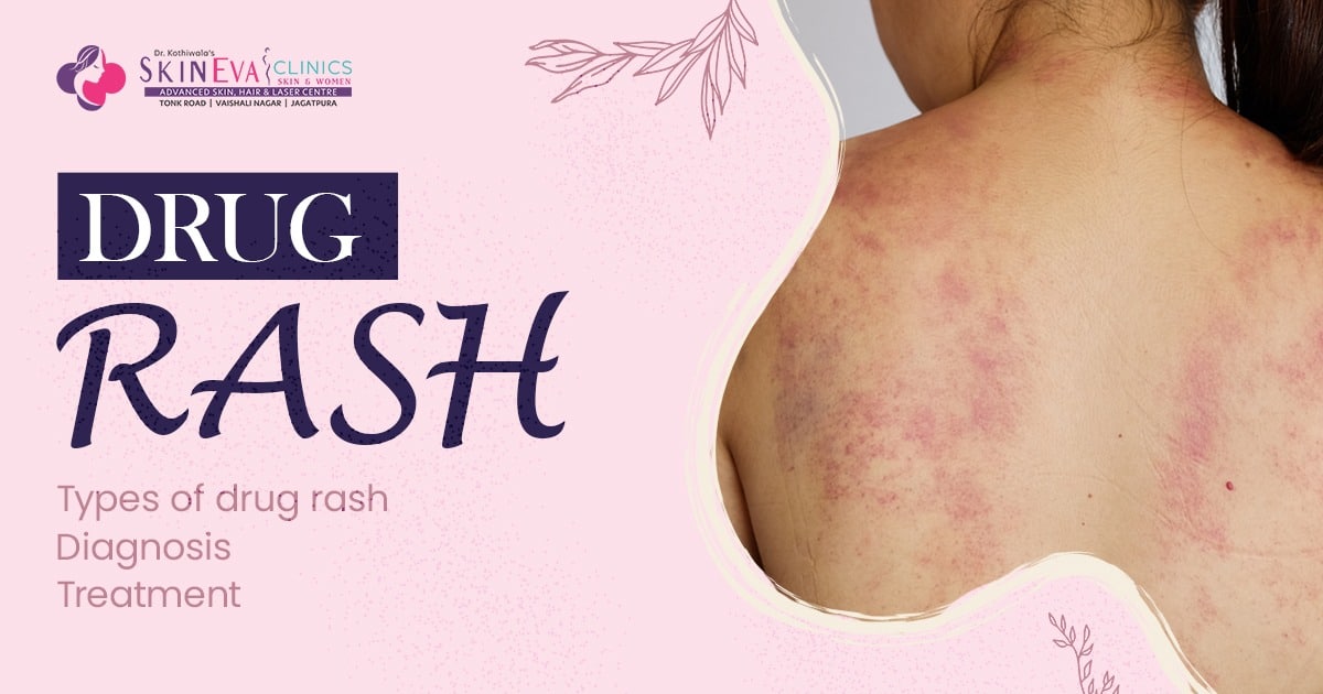 Drug rash treatment in jaipur, drug allergy cure, cost & doctor Jaipur