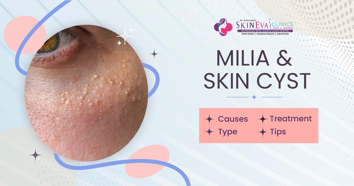 Milia removal treatment in Jaipur, Skin cyst removal in Jaipur, Cost ...