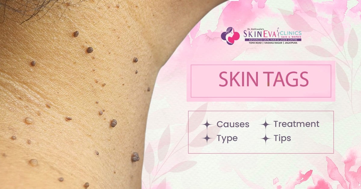 Skin Tag Treatment in Jaipur, Skin Tag Laser Removal Doctor & Cost