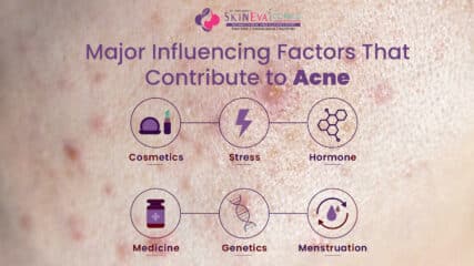 Top Major Influencing Factors That Contribute to Acne