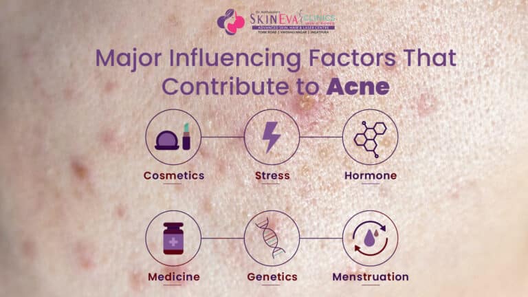 Top Major Influencing Factors That Contribute to Acne