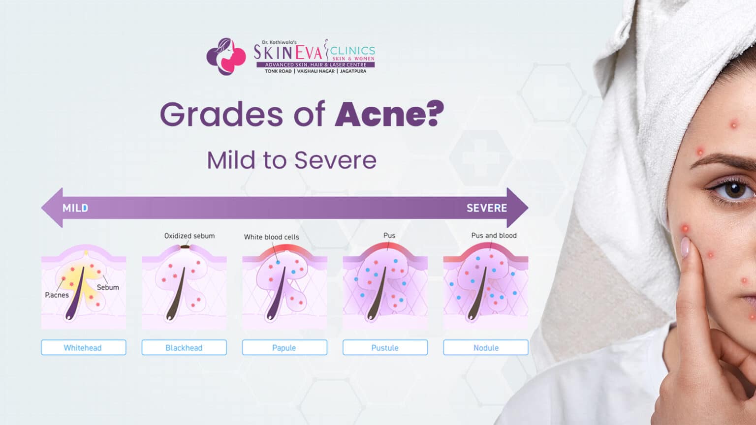 What Are Grades of Acne? Understanding the Different Types of Grades
