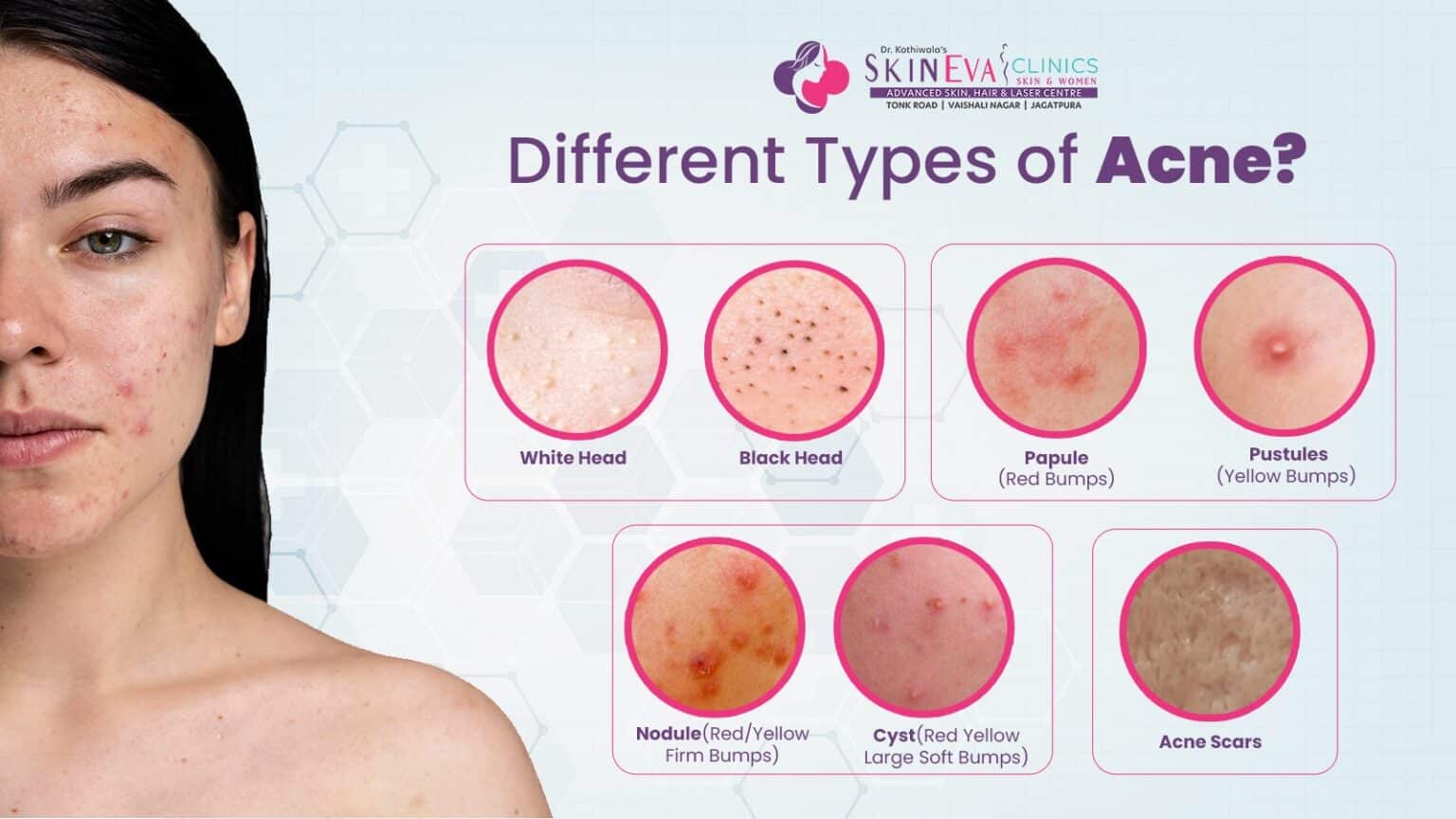 What Are the Different Types of Acne?