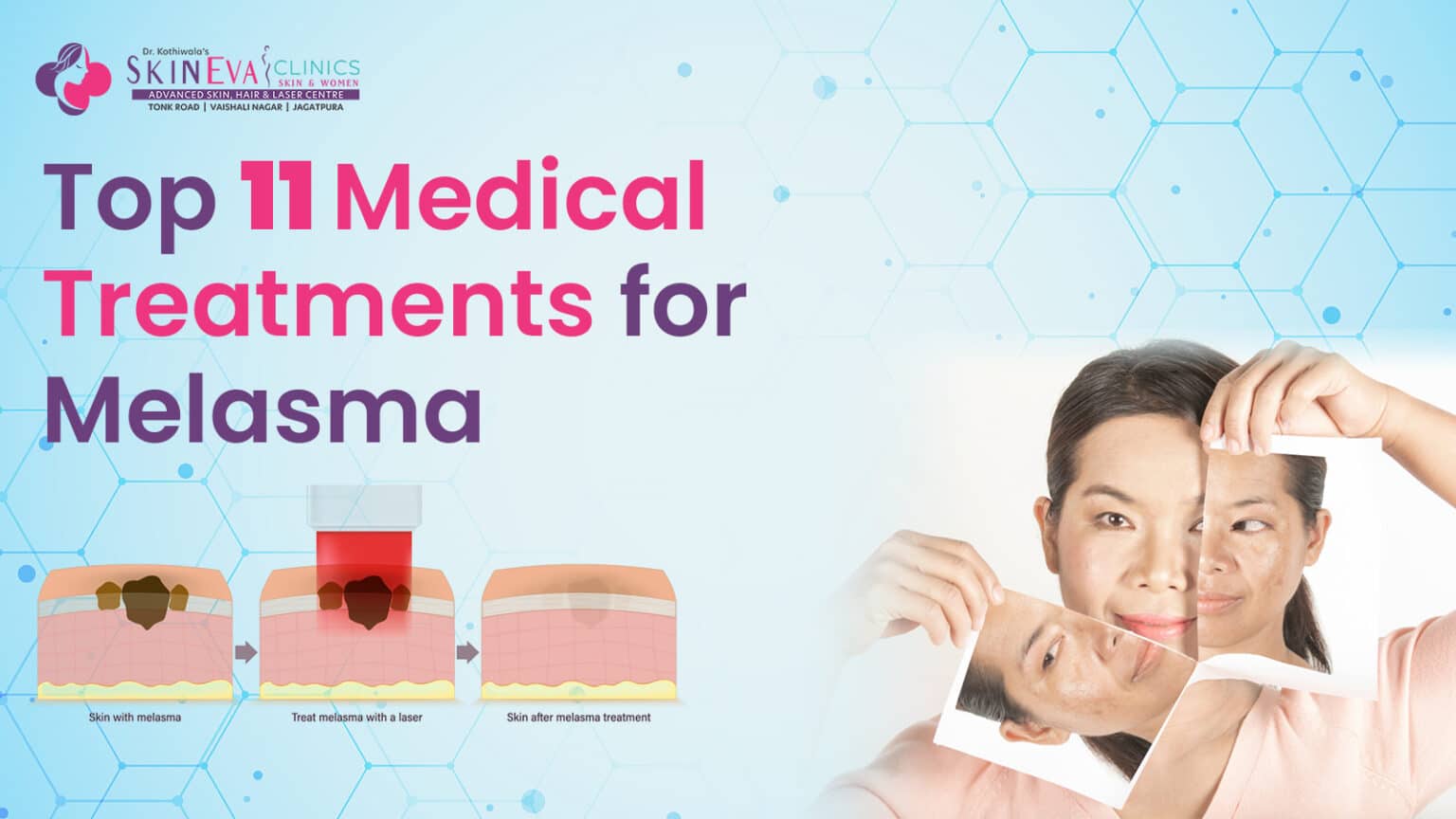Top 11 Medical Treatments for Melasma
